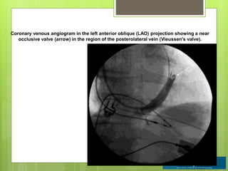 Coronary sinus anatomy | PPTX
