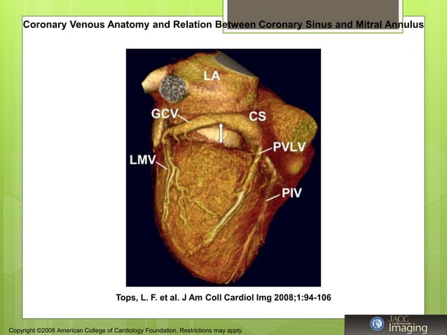 Coronary sinus anatomy | PPTX
