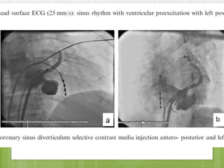 Coronary sinus anatomy | PPTX