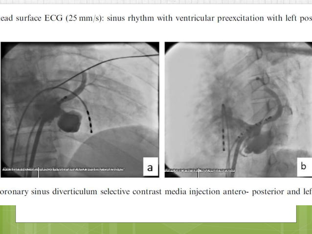 Coronary sinus anatomy | PPTX