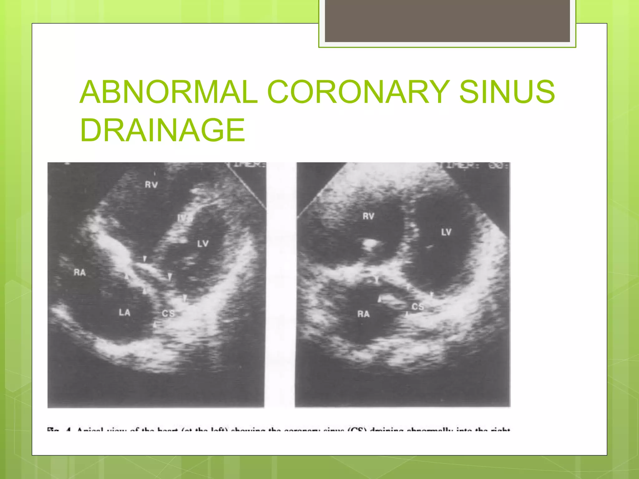 coronary_sinus_anatomy.pptx