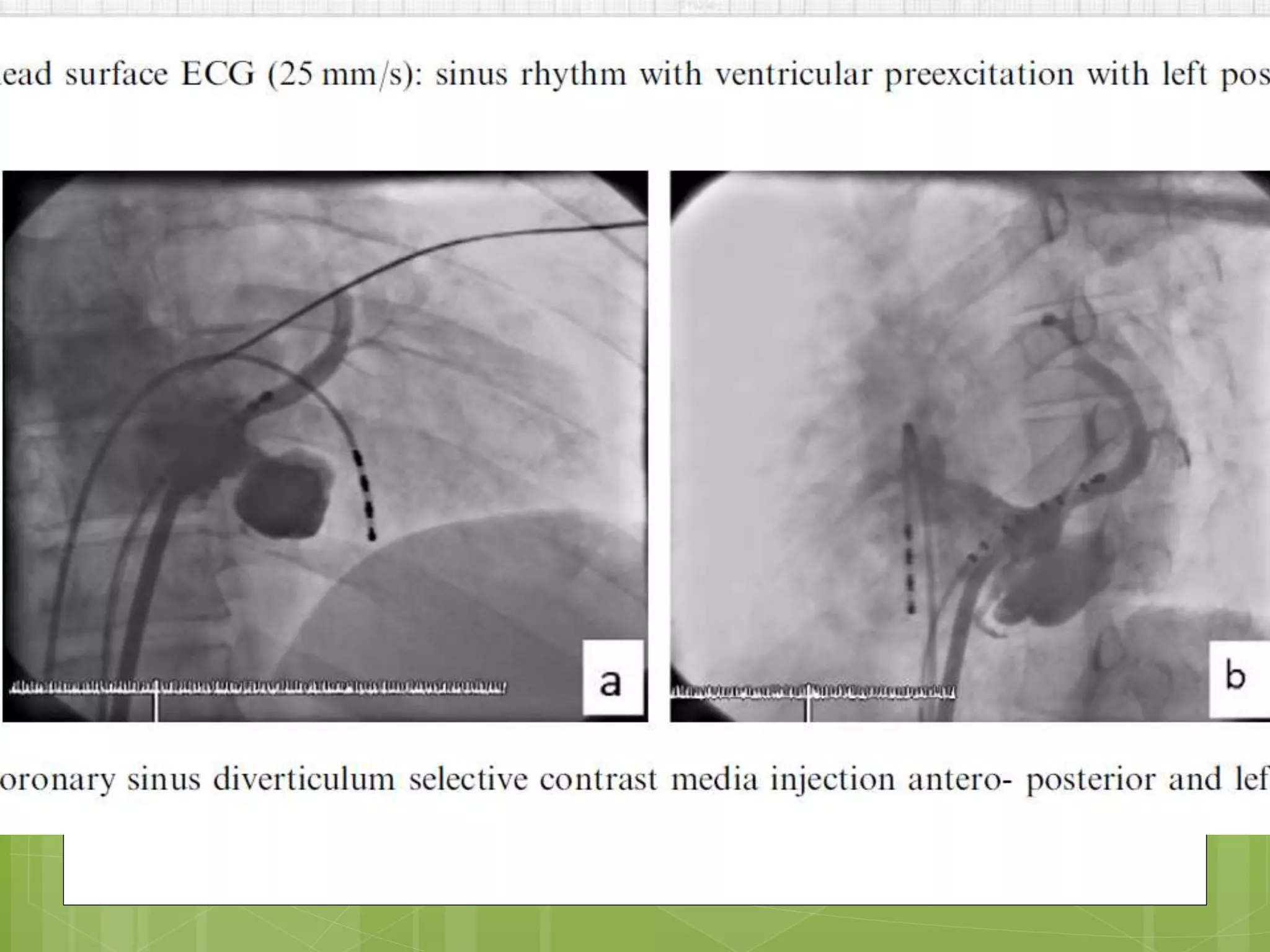 coronary_sinus_anatomy.pptx