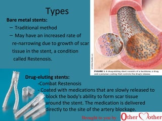 Coronary stent | PPT