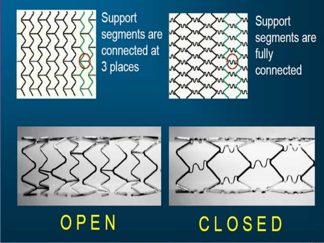 Different Coronary stent design PPT | PPTX