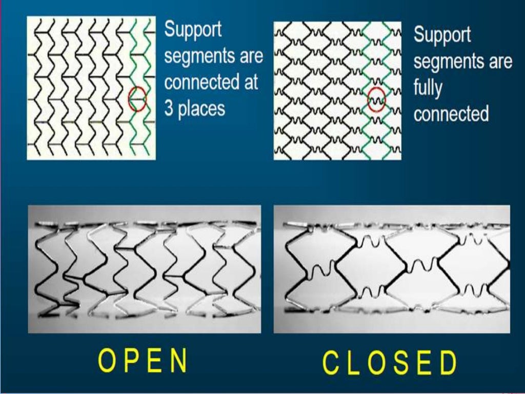 Different Coronary stent design PPT