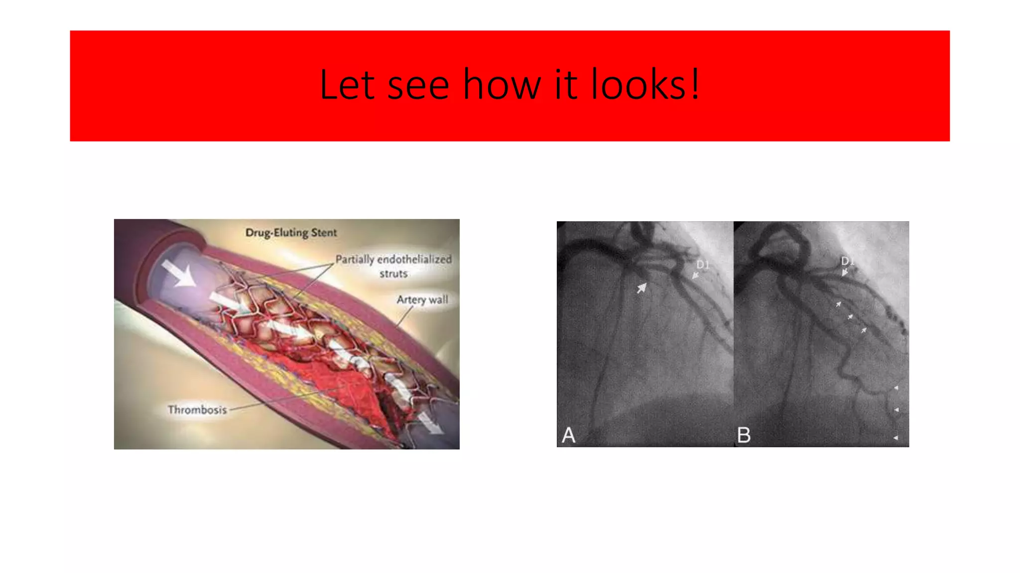 Coronary stent thrombosis | PPTX