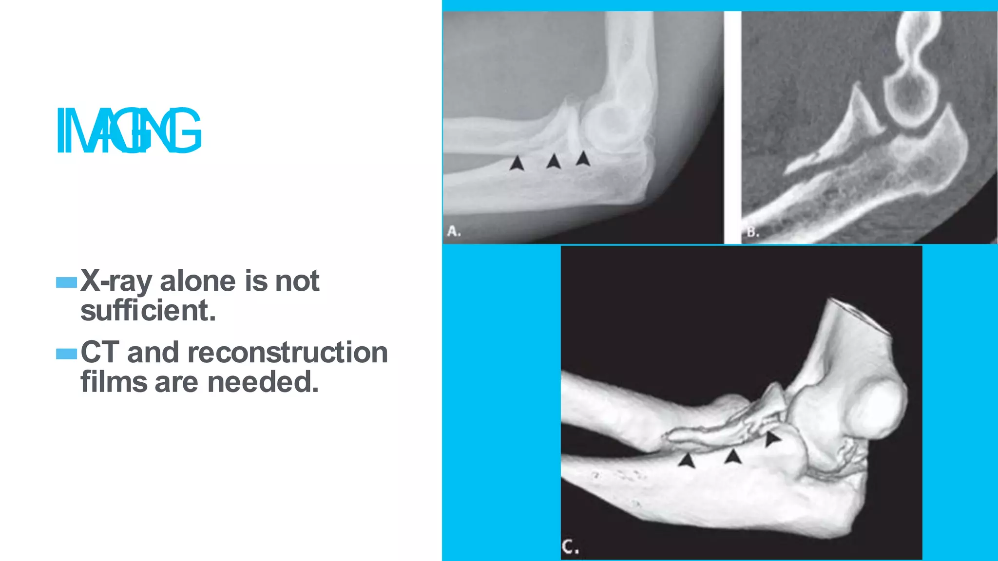 Coronoid fracture | PPTX