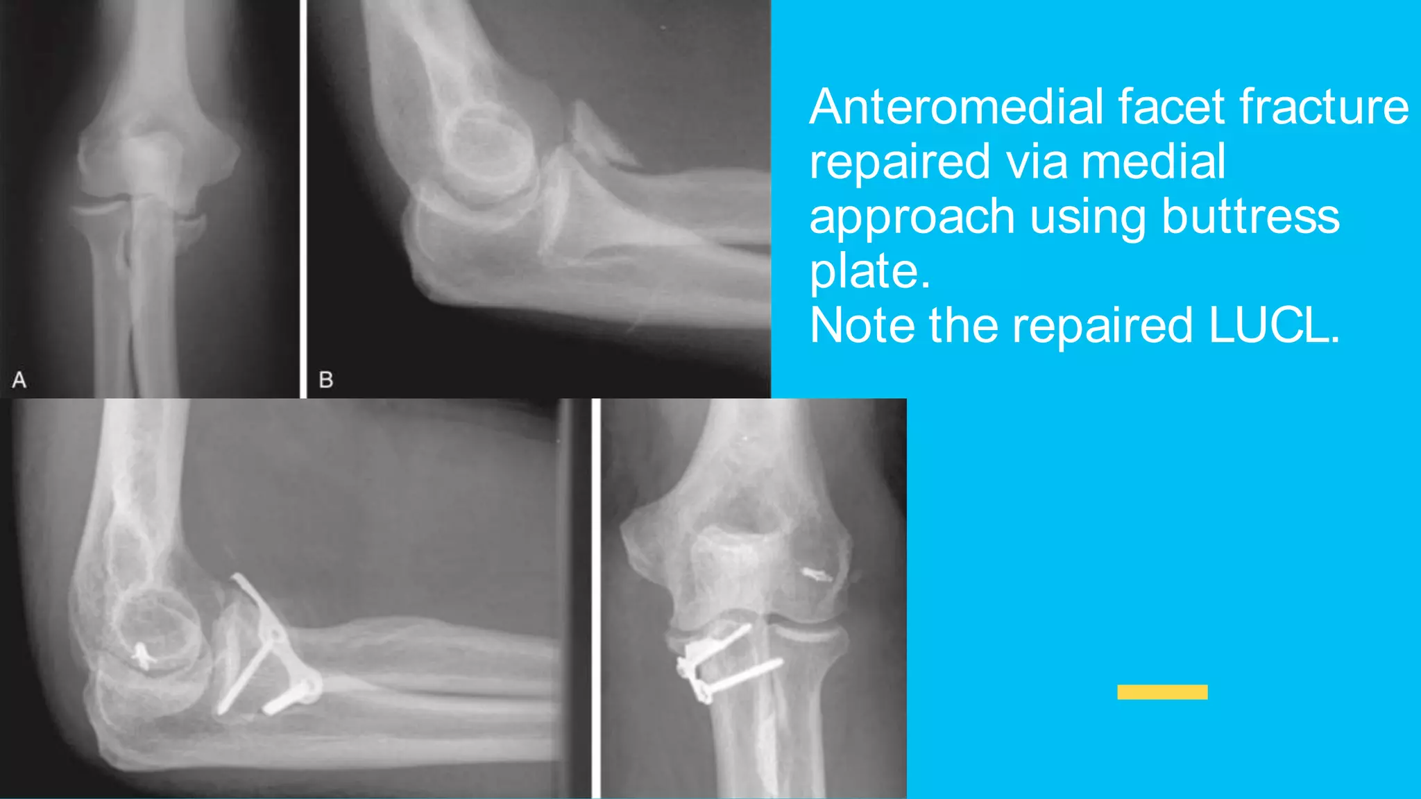 Coronoid fracture | PPTX