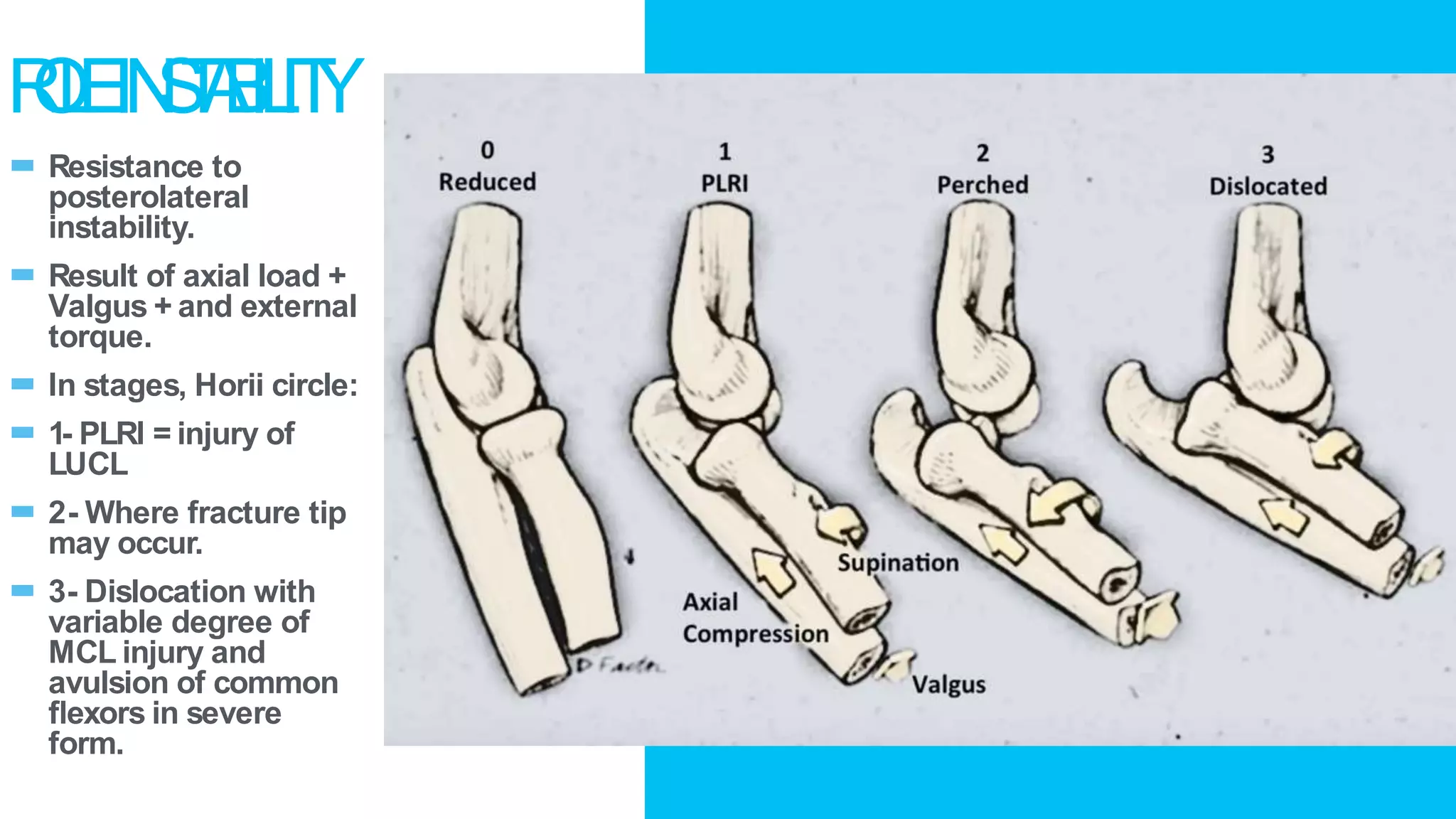 Coronoid fracture | PPTX