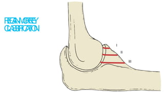 Coronoid fracture | PPTX