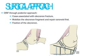 Coronoid fracture | PPTX