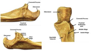 Coronoid fracture | PPTX