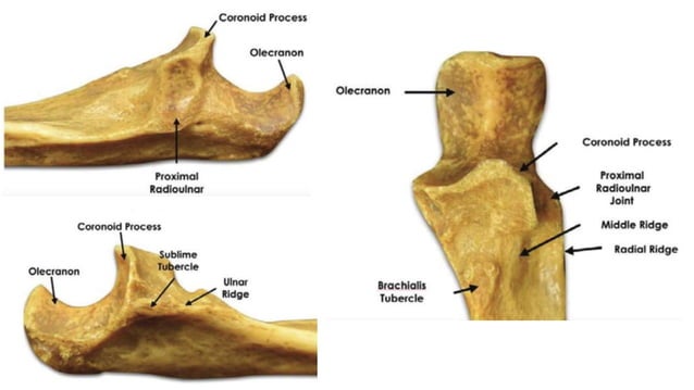 Coronoid fracture | PPTX