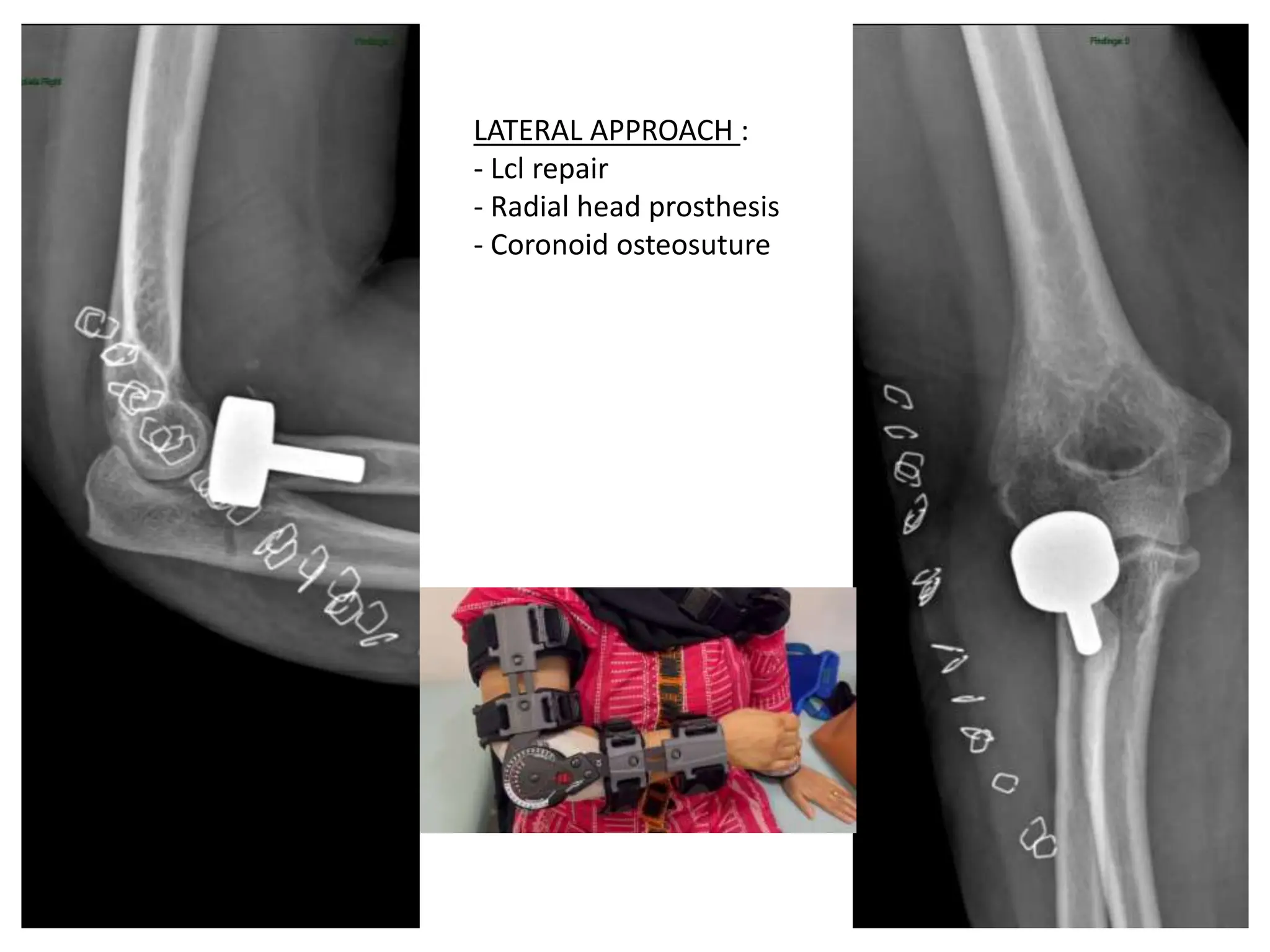 Coronoid fracture: Fix or Not?.pptx