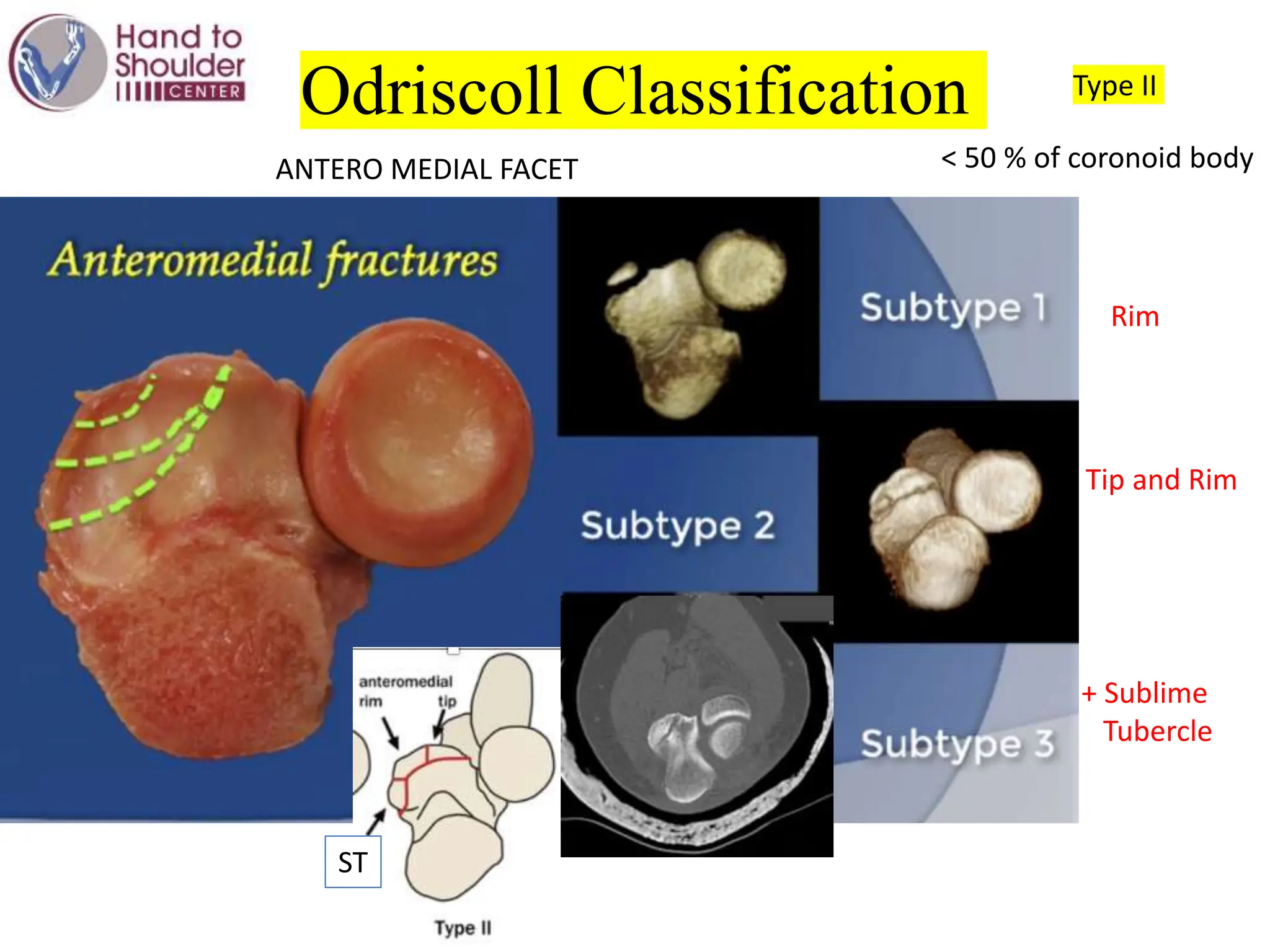 Coronoid fracture: Fix or Not?.pptx