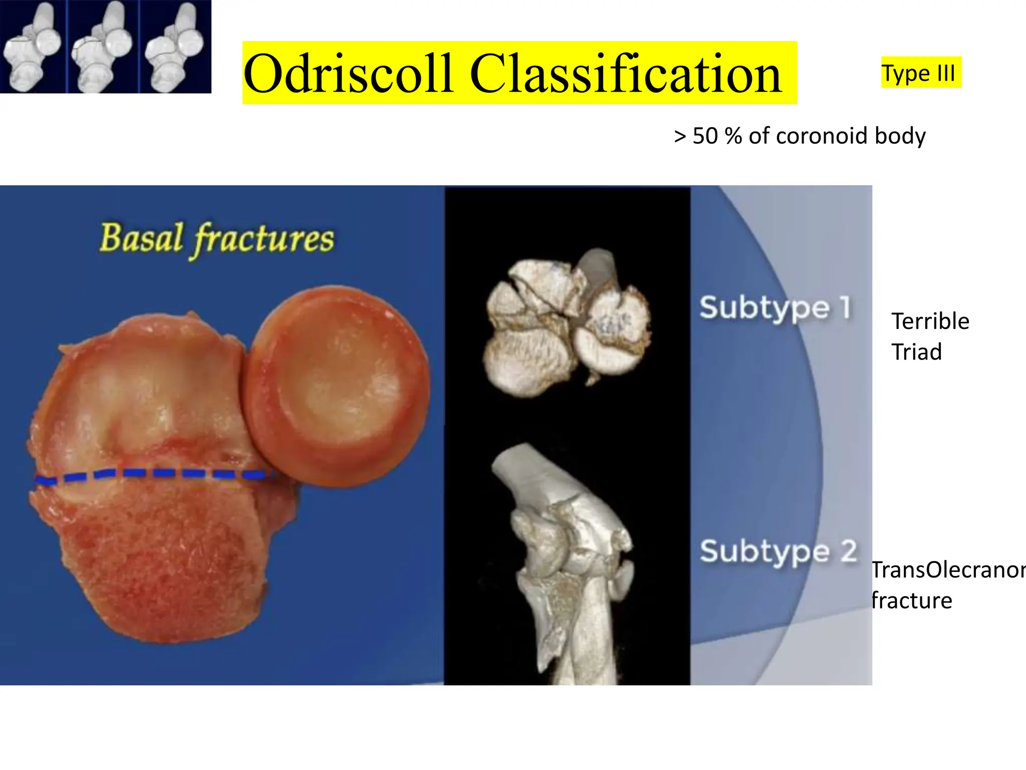 Coronoid fracture: Fix or Not?.pptx