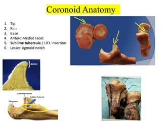 Coronoid fracture: Fix or Not?.pptx