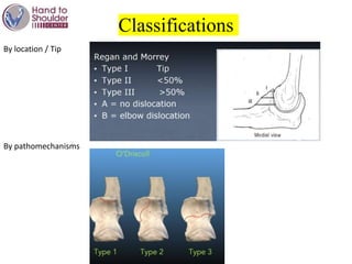 Coronoid fracture: Fix or Not?.pptx