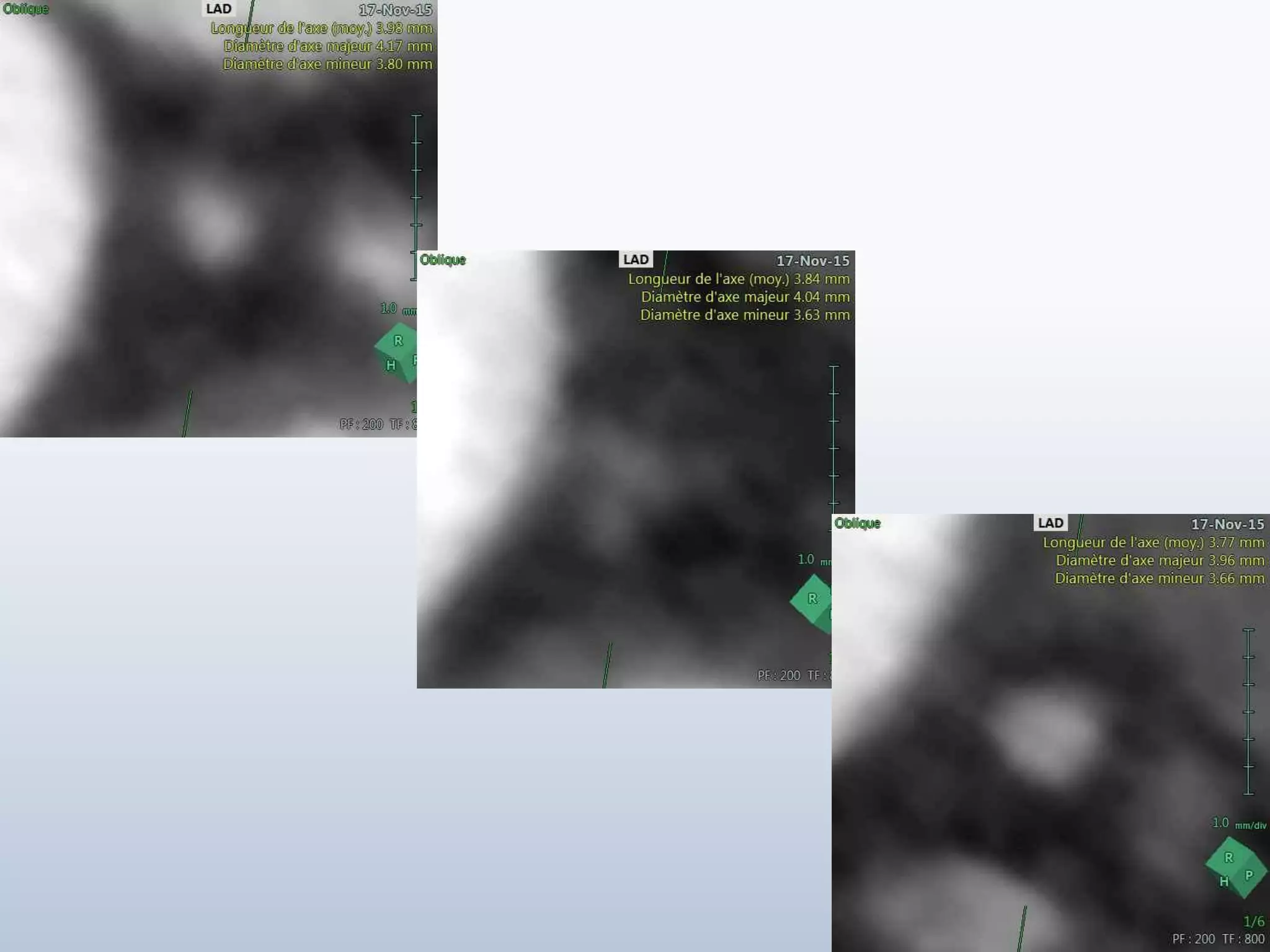 Coroscanner.... ou coronarographie | PPTX