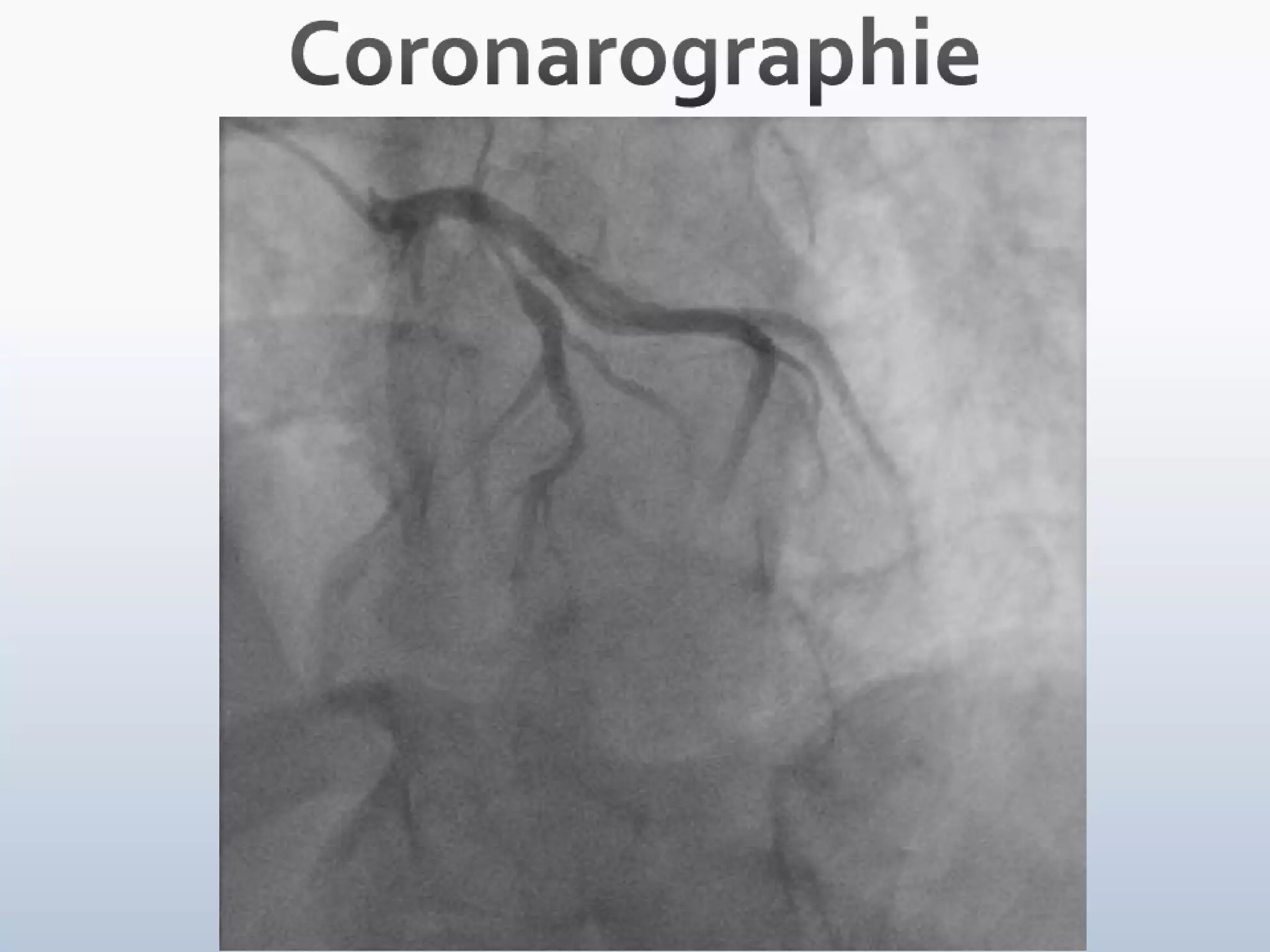 Coroscanner.... ou coronarographie | PPTX