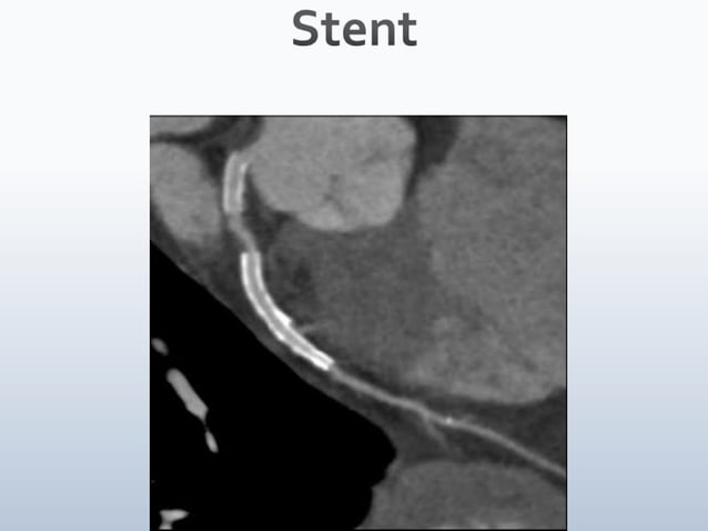 Coroscanner.... ou coronarographie | PPTX