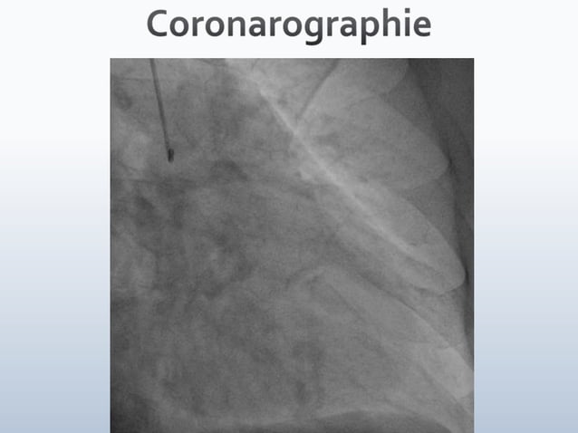 Coroscanner.... ou coronarographie | PPTX