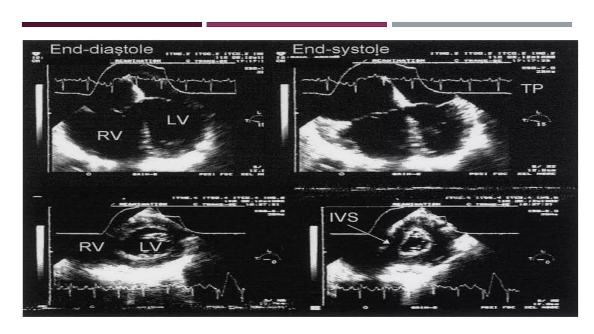 Cor pulmonale.pptx