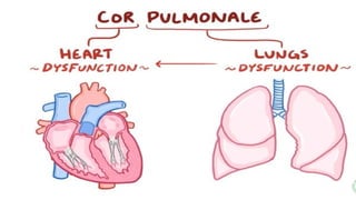 COR PULMONALE all information NursingProcess .pptx