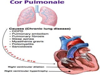 Cor pulmonaly | PPTX