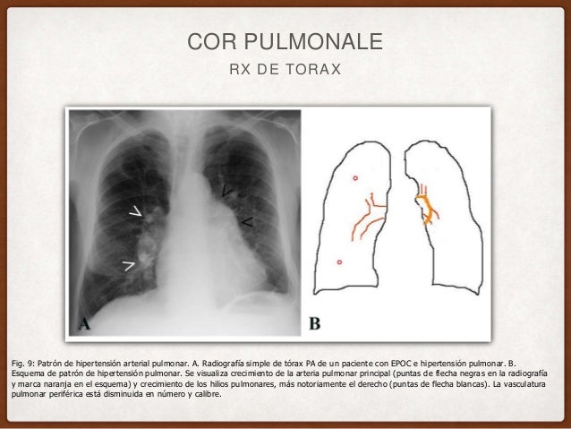 Cor pulmonare