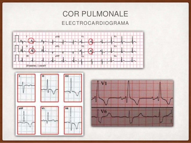 Cor pulmonare