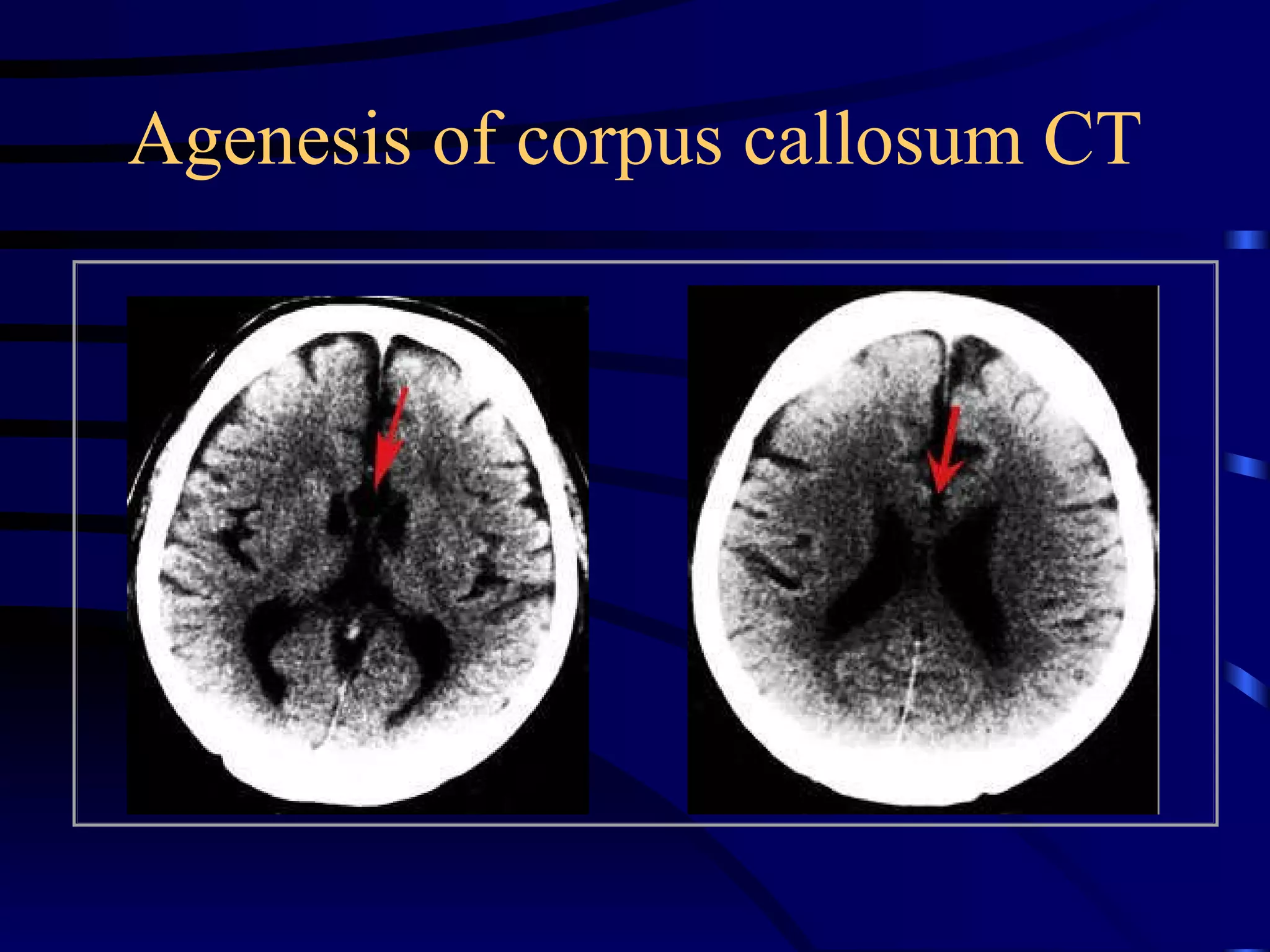 Corpus callosum | PPT