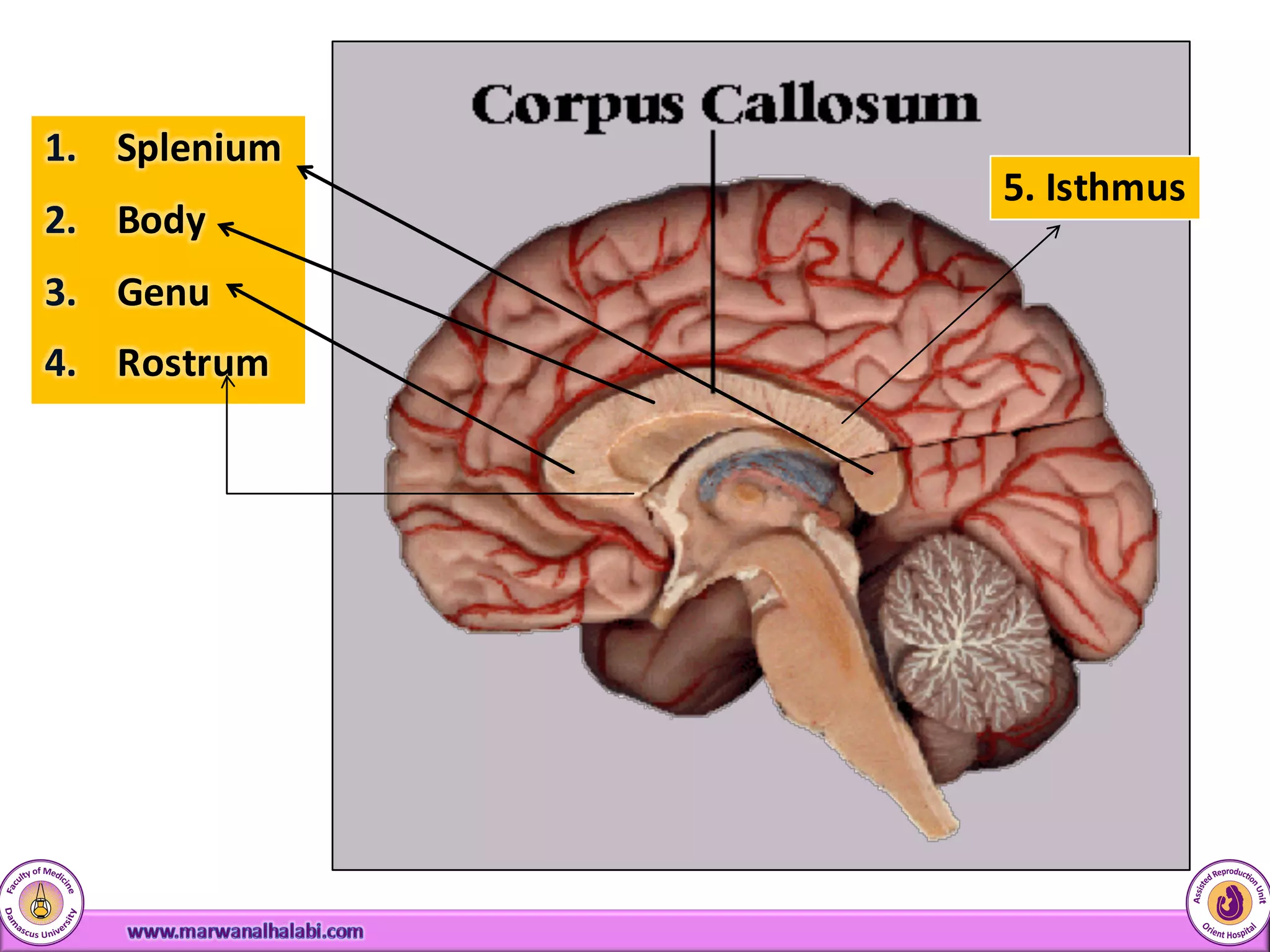 Corpus Callosum Anomalies | PDF