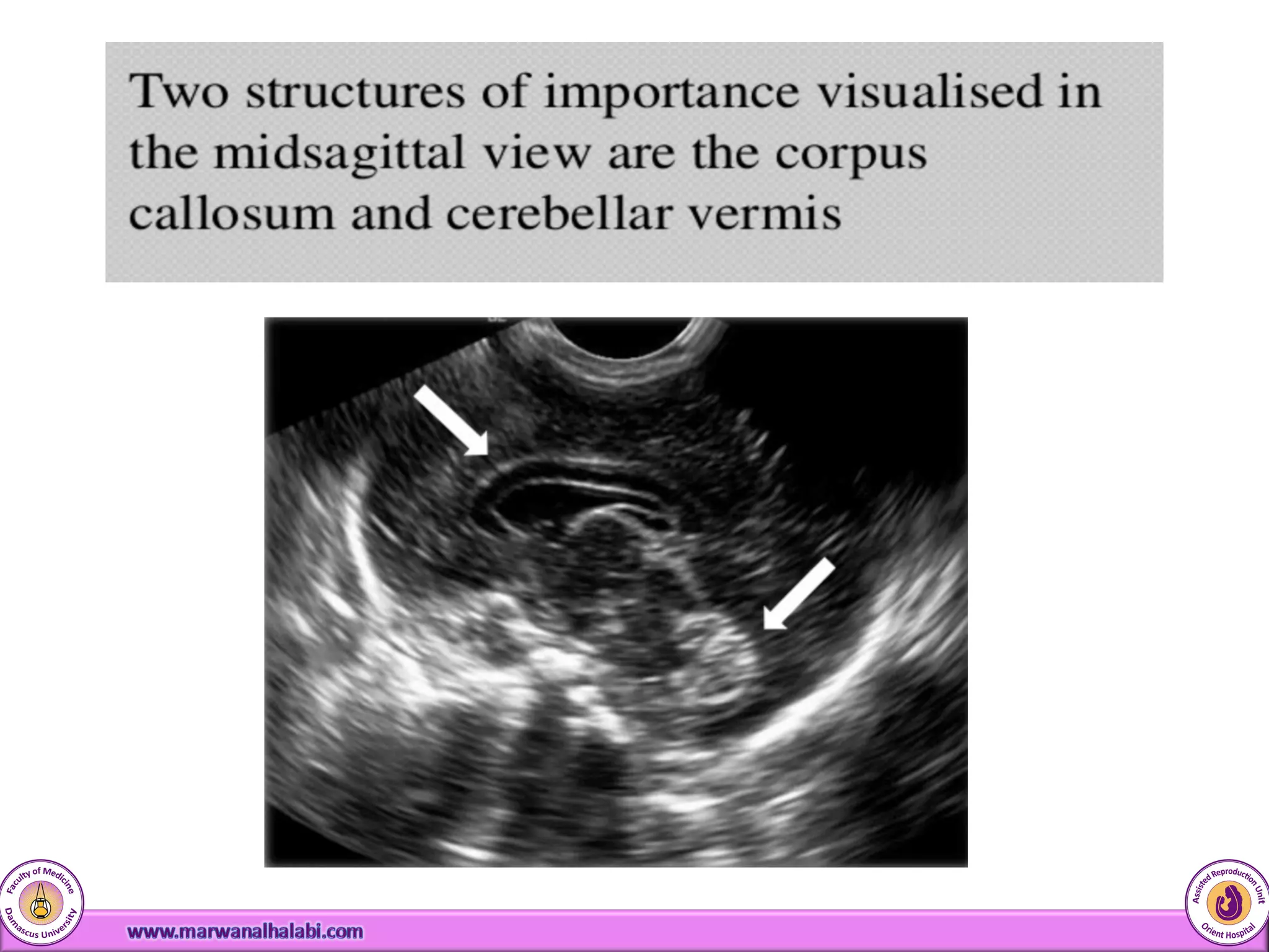 Corpus Callosum Anomalies | PDF