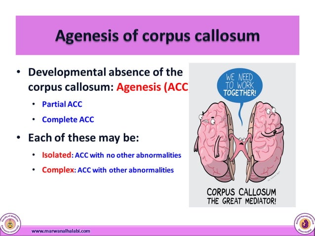 Corpus Callosum Anomalies | PPT | Free Download