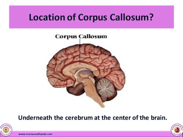 Corpus Callosum Anomalies | PDF
