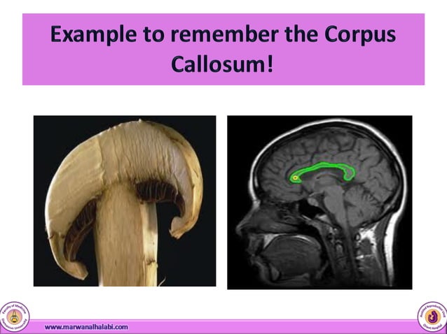 Corpus Callosum Anomalies | PDF
