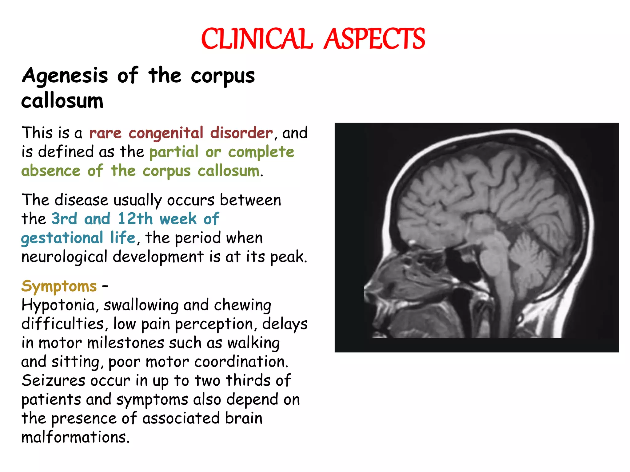 Corpus callosum | PPTX