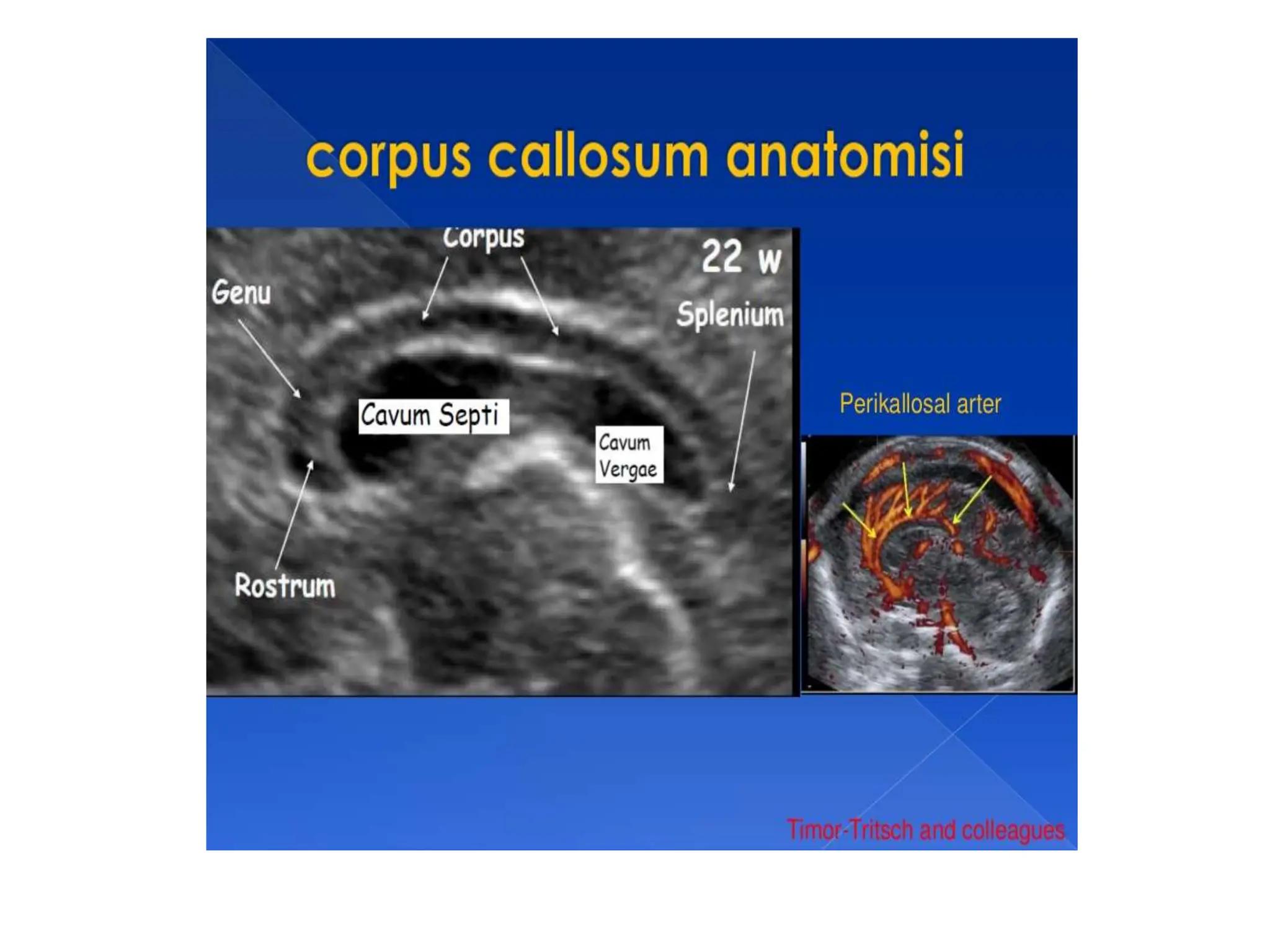 CORPUS CALLOSUM ULTRASONOGRAFİSİ DR.BAHRİ YILDIZ.pptx