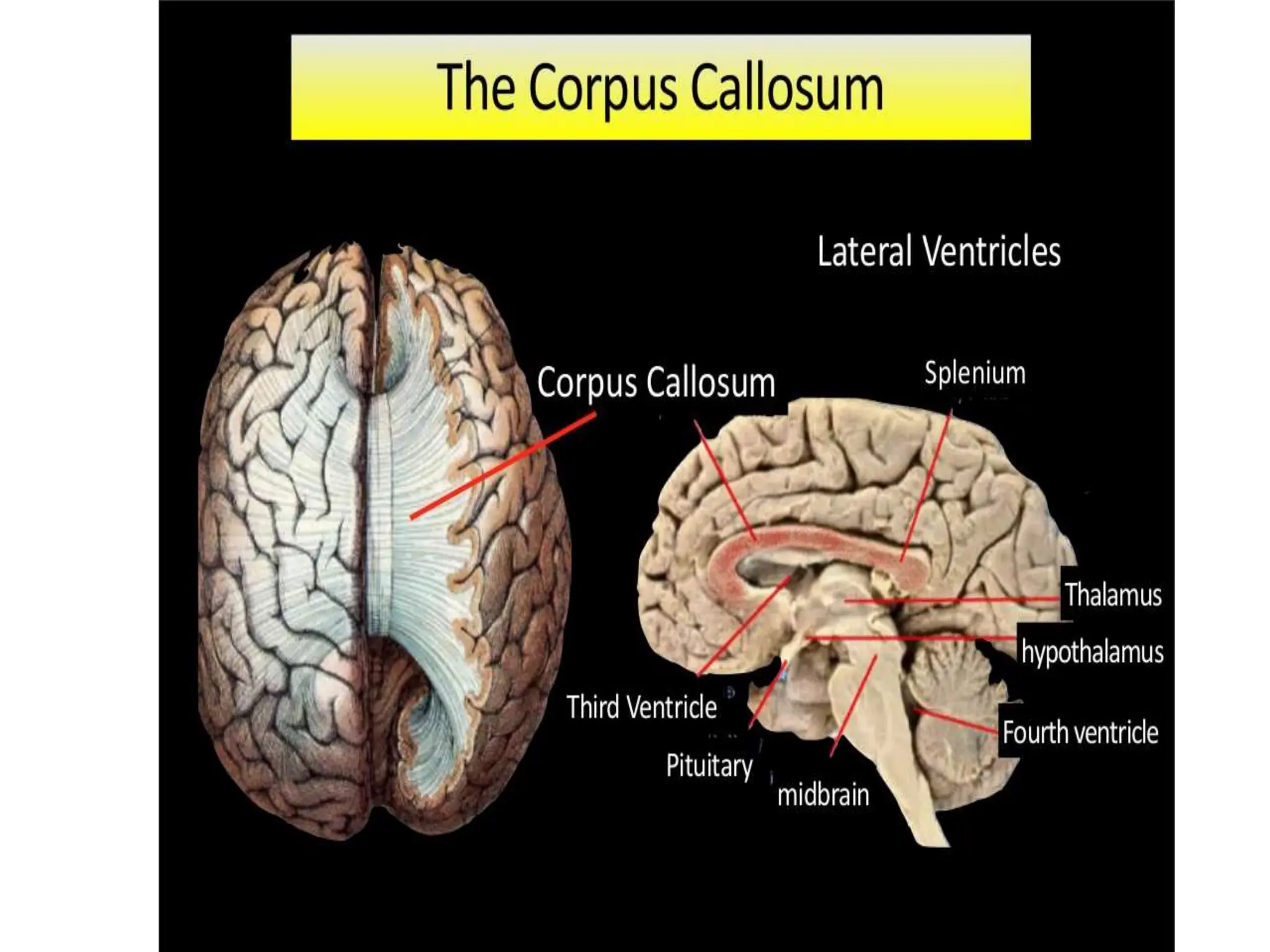 CORPUS CALLOSUM ULTRASONOGRAFİSİ DR.BAHRİ YILDIZ.pptx