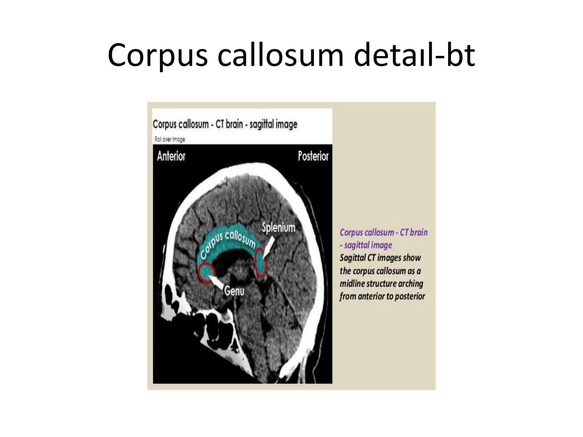CORPUS CALLOSUM ULTRASONOGRAFİSİ DR.BAHRİ YILDIZ.pptx