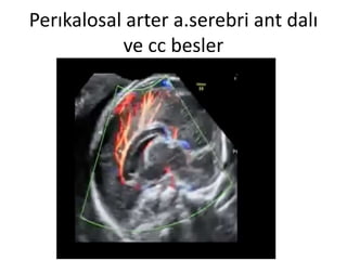 CORPUS CALLOSUM ULTRASONOGRAFİSİ DR.BAHRİ YILDIZ.pptx