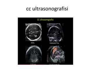 CORPUS CALLOSUM ULTRASONOGRAFİSİ DR.BAHRİ YILDIZ.pptx