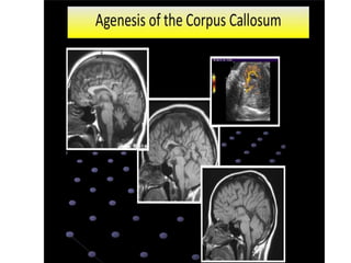 CORPUS CALLOSUM ULTRASONOGRAFİSİ DR.BAHRİ YILDIZ.pptx