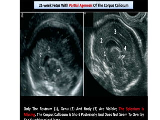 CORPUS CALLOSUM ULTRASONOGRAFİSİ DR.BAHRİ YILDIZ.pptx