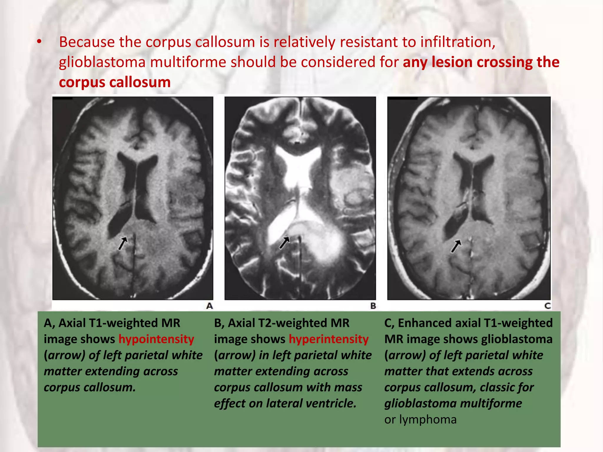 Corpus callosum with disconnection syndromes | PPTX