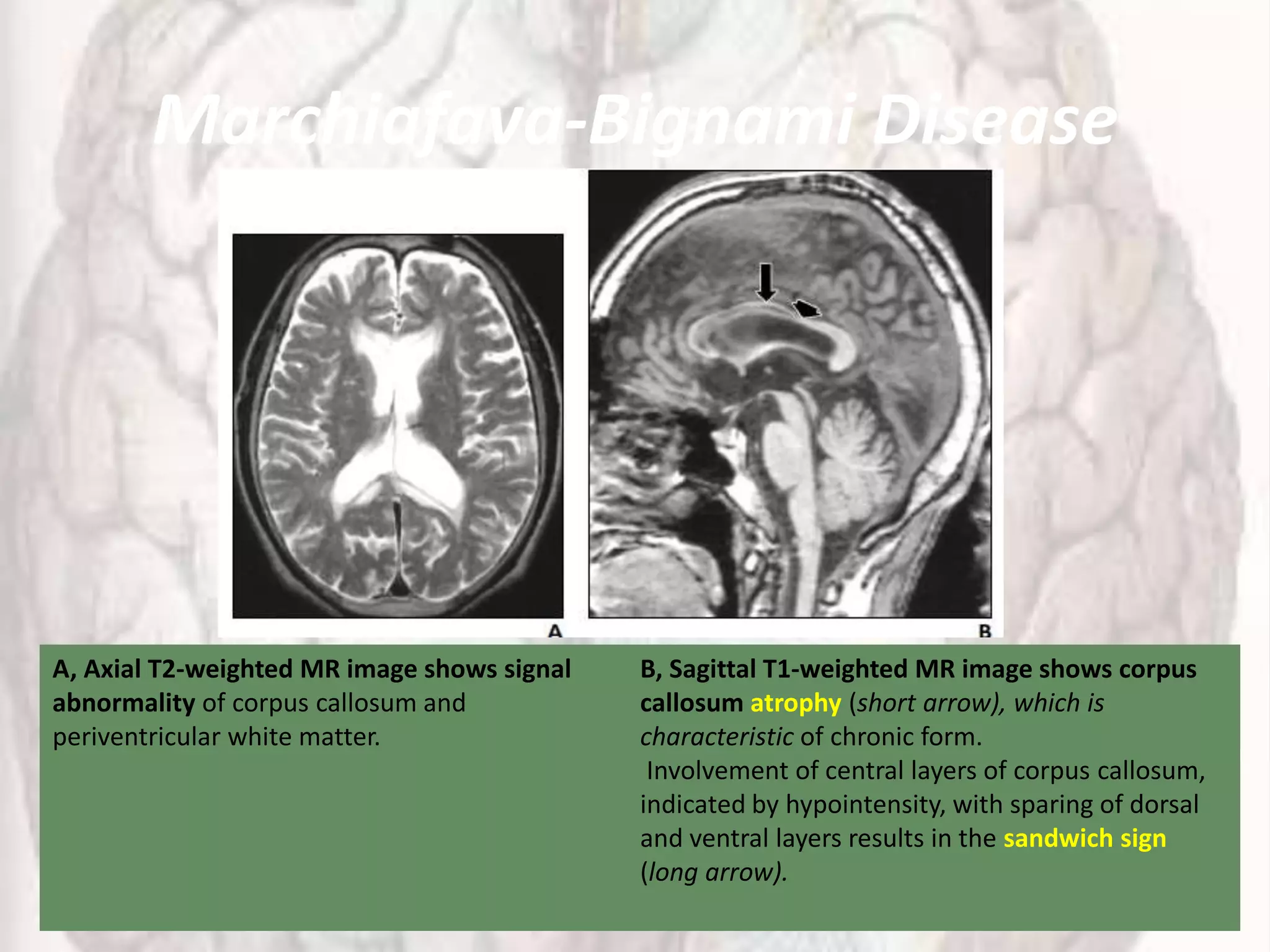 Corpus callosum with disconnection syndromes | PPTX