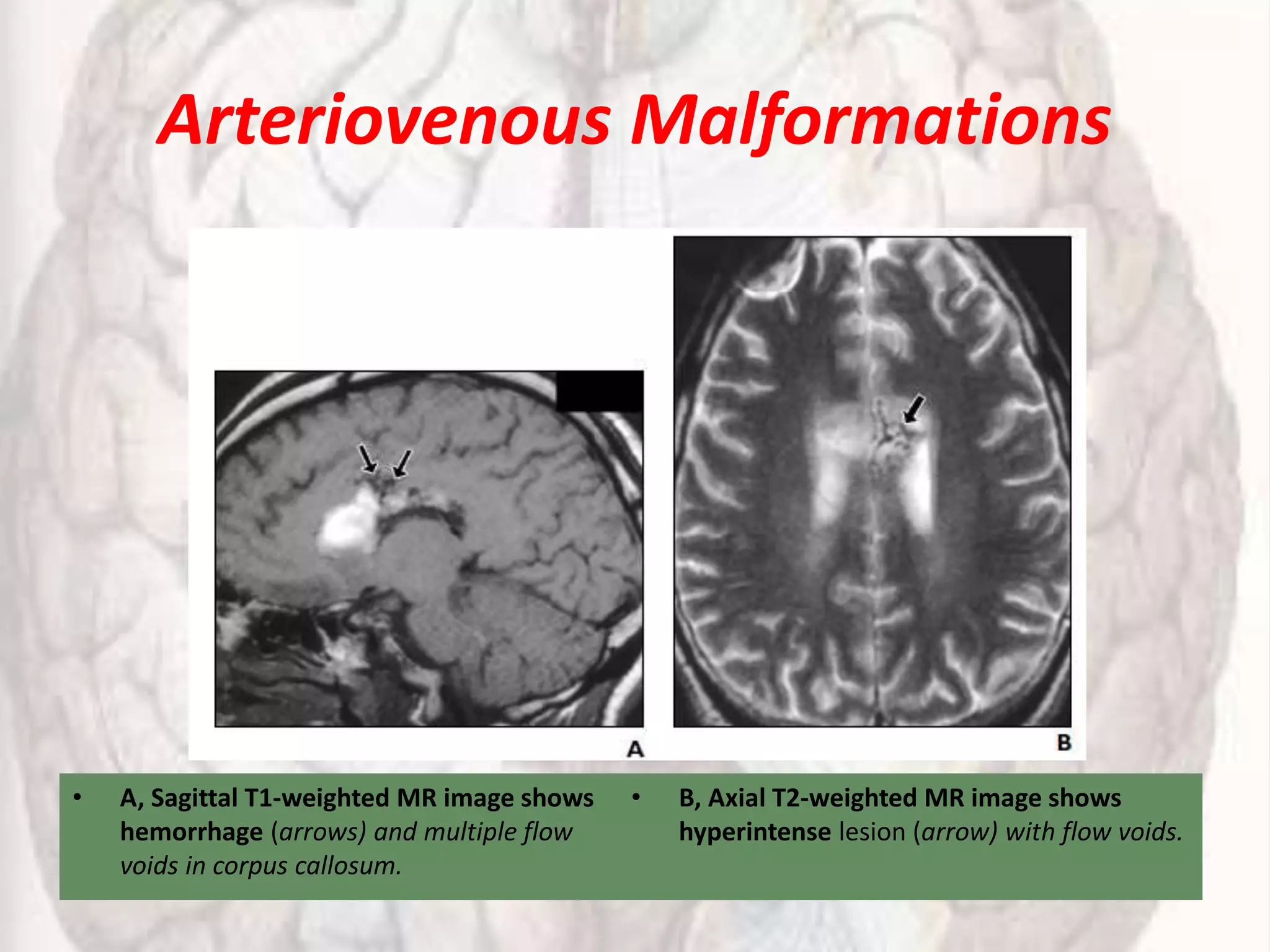 Corpus callosum with disconnection syndromes | PPTX