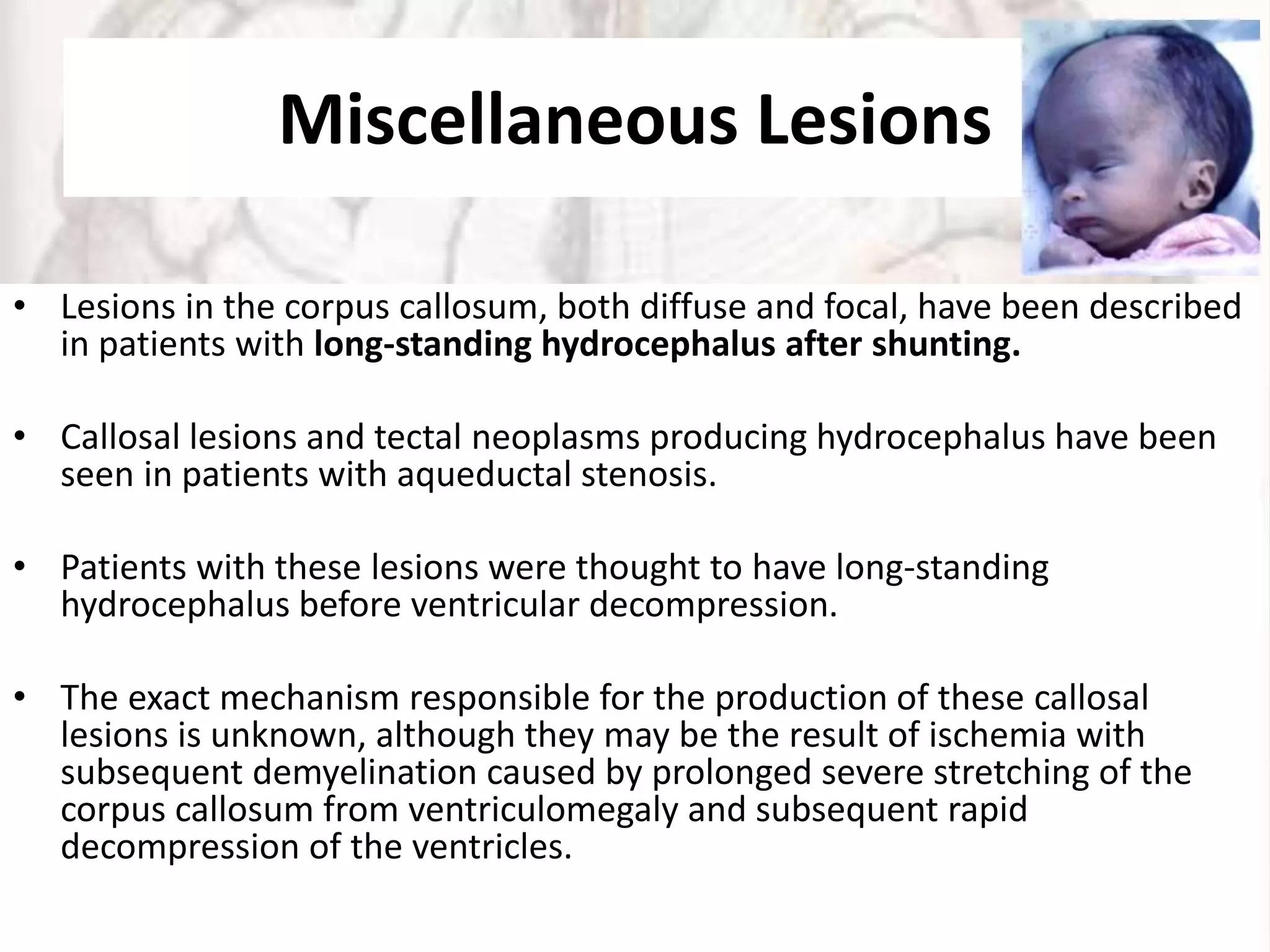 Corpus callosum with disconnection syndromes | PPTX