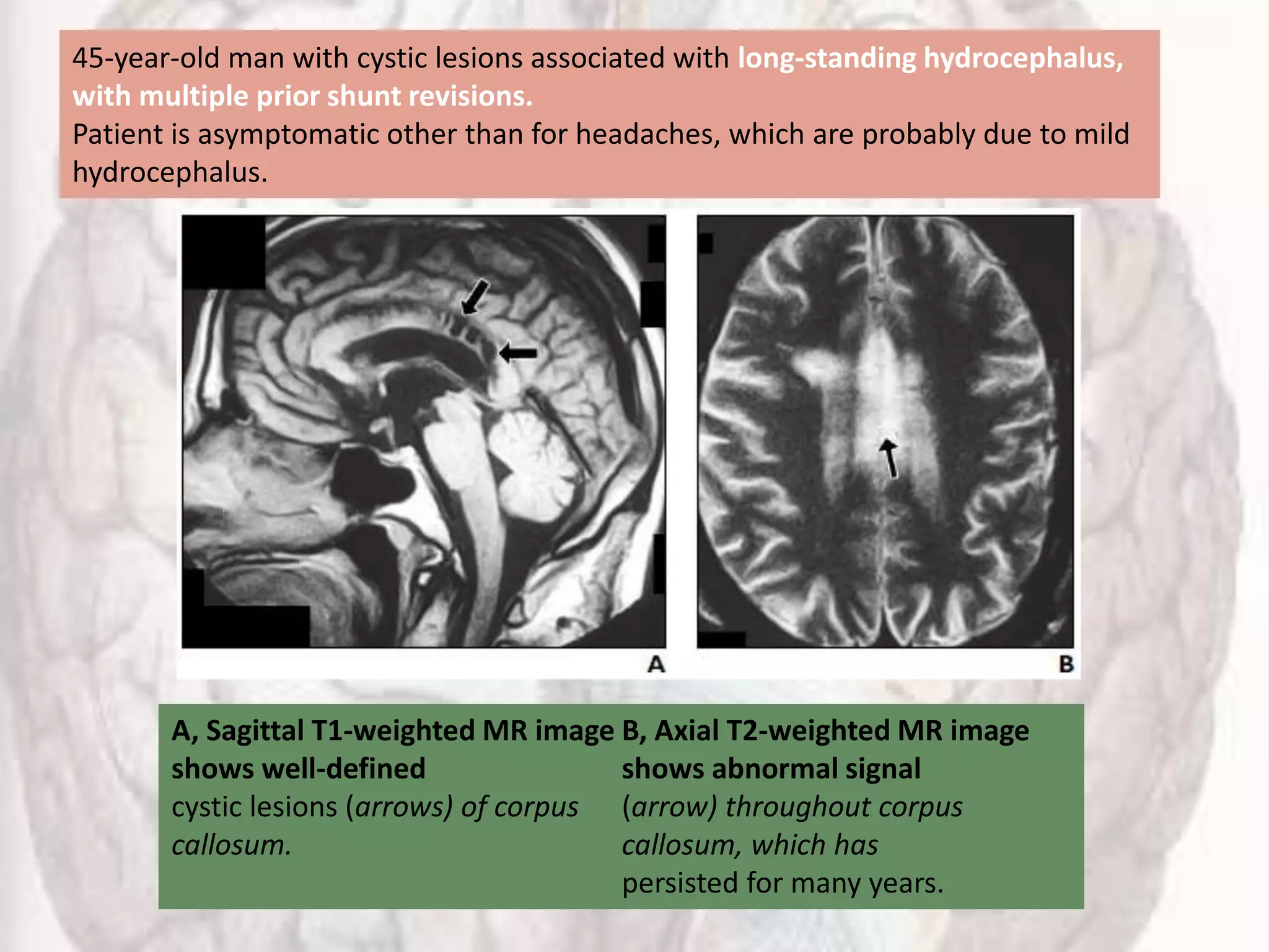Corpus callosum with disconnection syndromes | PPTX